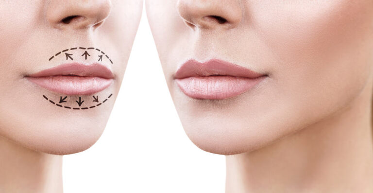 Lip Injections Aftercare | Toronto Plastic Surgery Center